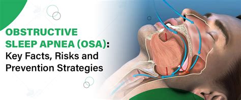 Obstructive Sleep Apnea Osa Causes Symptoms And Treatments