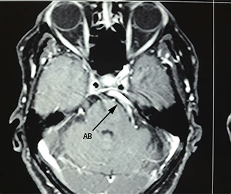 Axial Section Of T1 Contrast Magnetic Resonance Imaging Showing