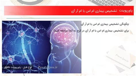 تشخیص بیماری ام اس با ام آر آی