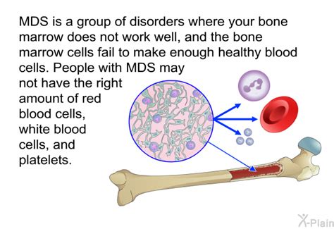 myelodysplastic syndromes or mds