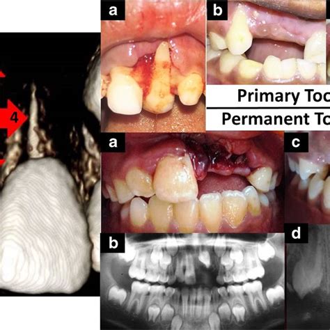Various Types Of Avulsed Tooth Storage Media Dmem Dulbecos Modified Download Scientific