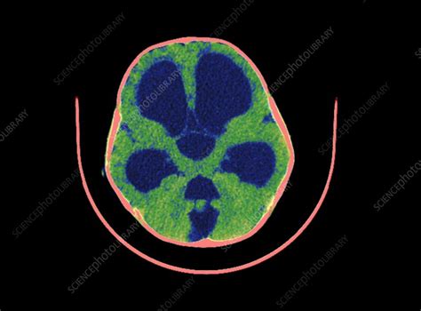 Hydrocephalus Ct Scan Stock Image F043 8942 Science Photo Library