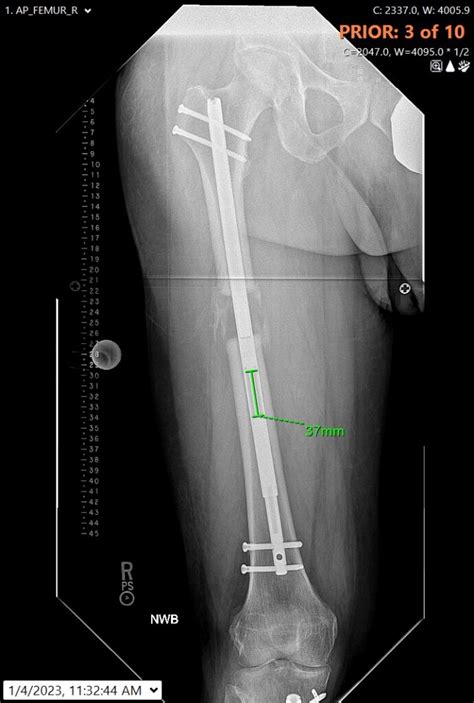 Limb Lengthening Overview Limb Lengthening