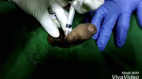 Local Anesthetic For Circumcision