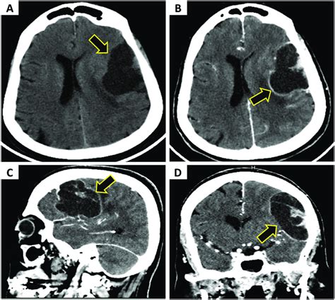 Computed Tomography Ct Scan With A Axial Ct Without Contrast B Download Scientific