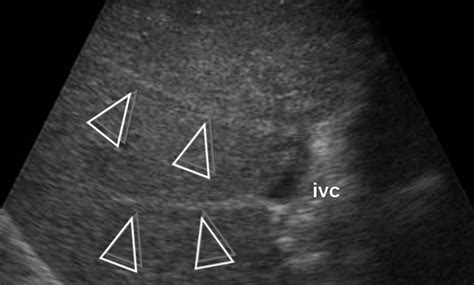 Sonography Of Budd Chiari Syndrome Ajr