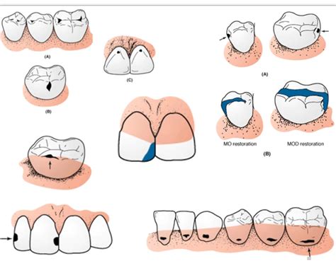 Cavity Classifications Quiz