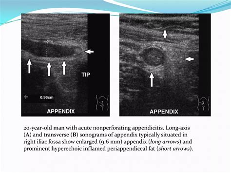 Ultrasound Imaging Of Bowel Pathology Pptx