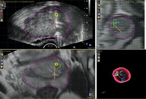Mrultrasound Fusion Guided Biopsy Of The Prostate A Better Way To