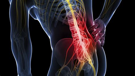 Pinched Nerves Chiropractic Healthcare