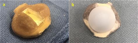 A Resurfaced Artificial Sawbones Patella After Bone Patellar Tendon