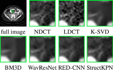 Figure 1 From Low Dose Ct Denoising Using A Structure Preserving Kernel