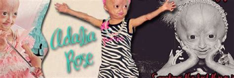 Adalia Rose Rose Adalia Twitter