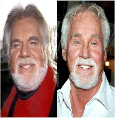 Kenny Rogers Plastic Surgery