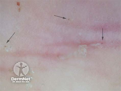 Scabies Dermoscopy Sign