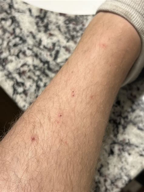 Does This Look Like A Bed Bug Or Scabies Bite R Bugbites