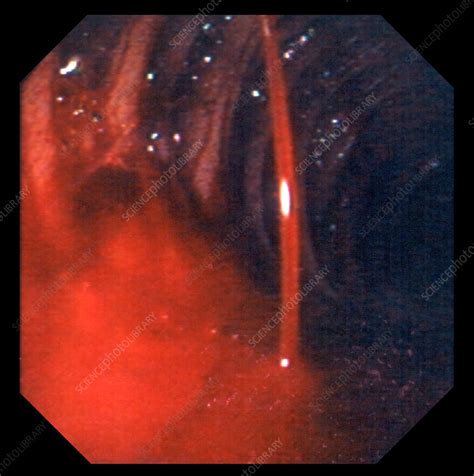 Bleeding Stomach Ulcer Stock Image M280 0203 Science Photo Library