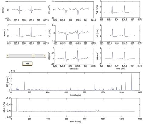 Ecg Of Type 2 Diabetic Patient With Cvds Download Scientific Diagram