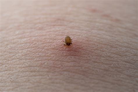 인간의 피부에 진드기 매크로 사진을 빠는 익소드 리시누스 부풀어 오른 기생충은 분홍색 자극표에 물린다 작은 빨간 방울 위험한