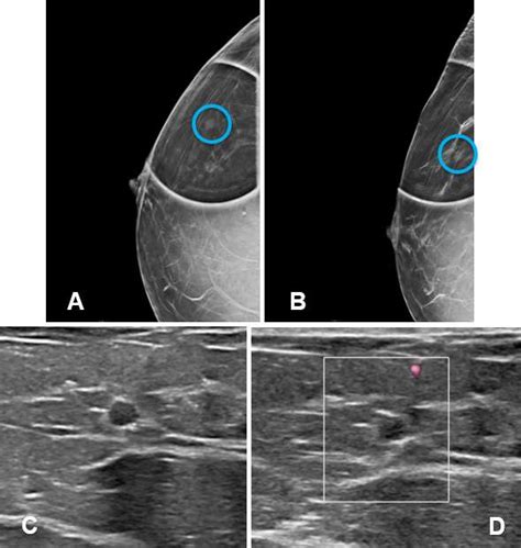 Simple Cyst Clustered Microcysts Complicated Cyst Radiology Ucla Health