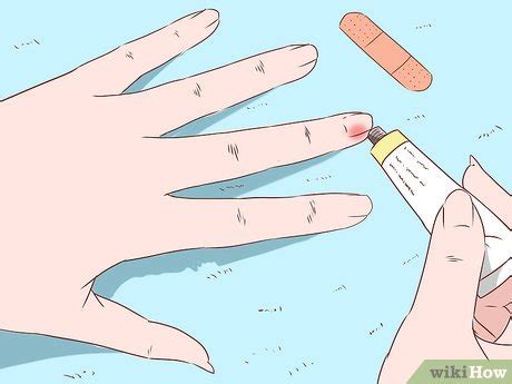 How To Remove A Splinter Removal Methods