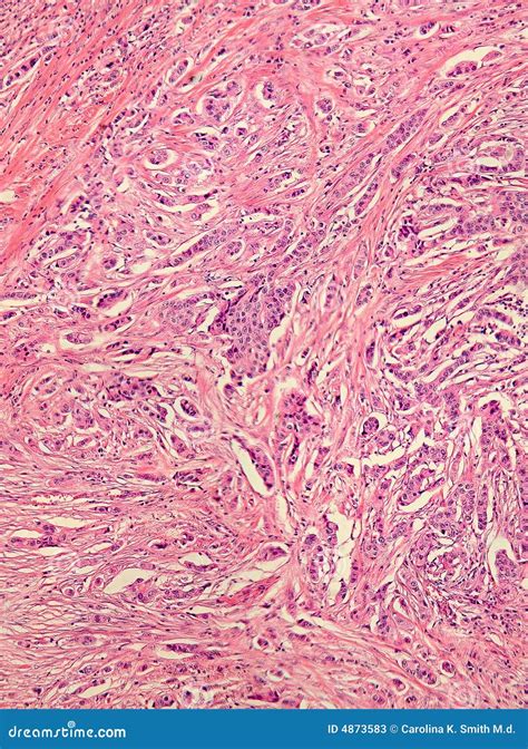 Breast Cancer Histology Stock Image Image Of Pathology 4873583
