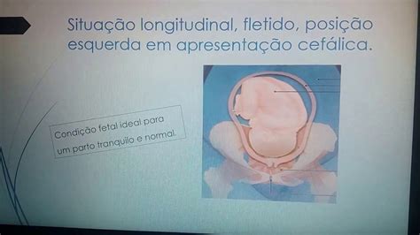Feto Em Casos De Feto