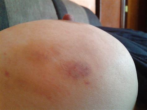 Bruises Porn Pictures Xxx Photos Sex Images 4026267 Pictoa