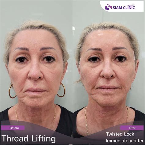 Thread Lift Before And After Photos Siam Clinic Thailand