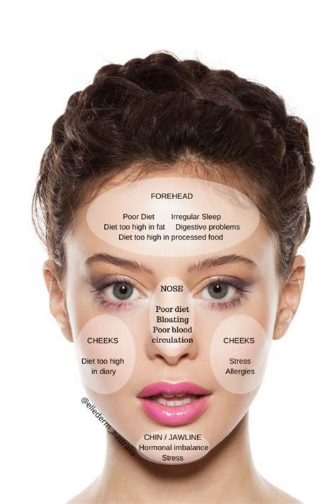 Acne Face Map Decoding The Pimples On Our Face Face Acne Acne Diet Face Mapping Acne