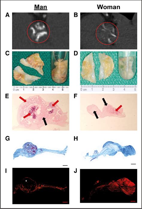Figure 1 From Sex Related Discordance Between Aortic Valve
