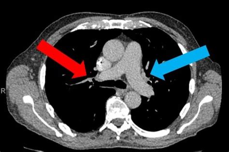 Vanishing Bile Duct Syndrome Associated With Non Hodgkins Lymphoma And Hepatitis E Virus