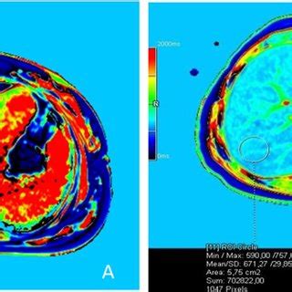 T Mapping Images Demonstrates A T Relaxation Time Of Ms In A Download Scientific Diagram