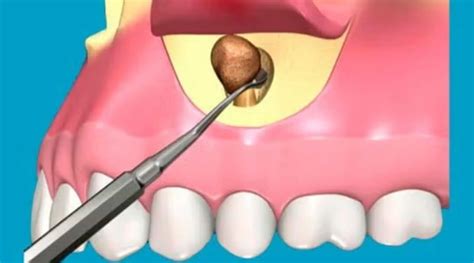 Curetaje Apical Clinica Dental Sonrisa Segura