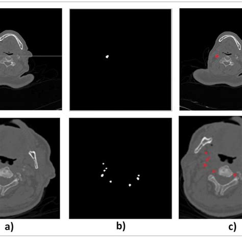 Region Growing Segmentation In Cta Image Download Scientific Diagram