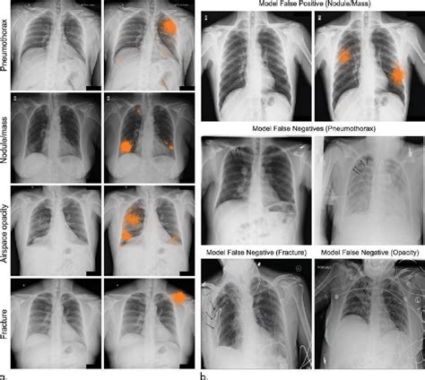 Table 1 From Chest Radiograph Interpretation With Deep Learning Models Assessment With