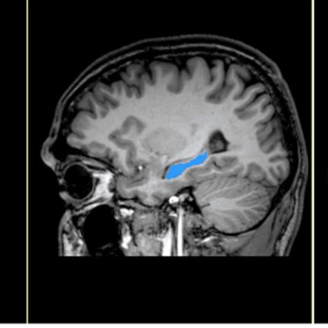 Hippocampus Annotated Dataset Kaggle