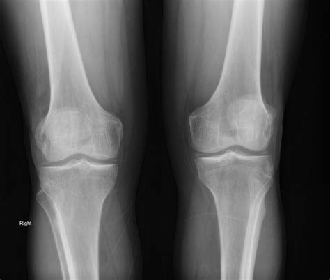 Chondrocalcinosis Radiology Reference Article