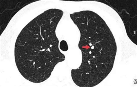 What Is Lung Nodular Density At Nadia Arsenault Blog