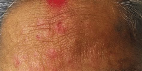 Showing Erythematous Rash Over The Cheeks And Forehead Figure 2