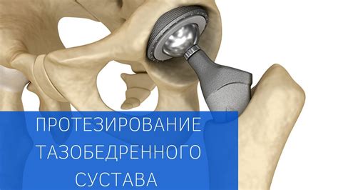 Протезирование тазобедренного сустава программа реабилитации Youtube
