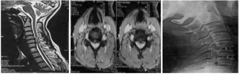 Mri Cervical Spine Sagittal A And Axial B Views Showing Multiple
