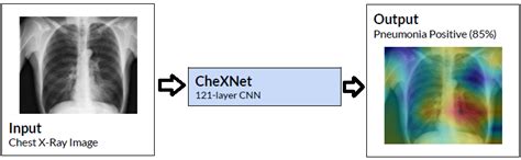 Review — Chexnet Radiologist Level Pneumonia Detection On Chest X Rays With Deep Learning By