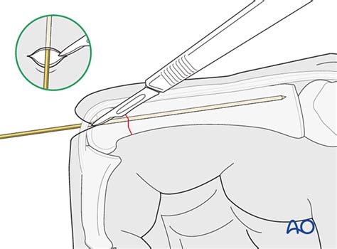 Intramedullary Screw Fixation For Transverse Extraarticular Fracture Of The Distal End Segment
