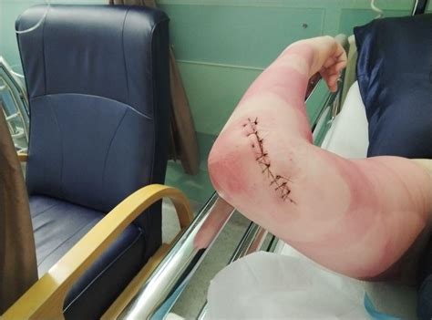 Left Ulnar Transposition Rcubitaltunnel