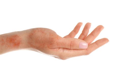 The Genesis Of Xeroderma Pigmentosum Bldg Active