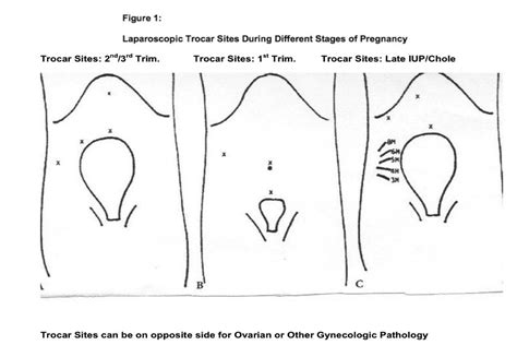Laparoscopic Appendectomy Port Placement