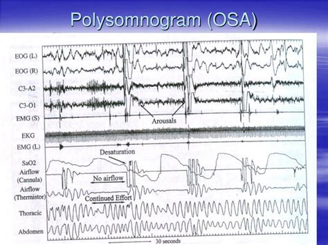 Ppt Obstructive Sleep Apnea Osa Powerpoint Presentation Free