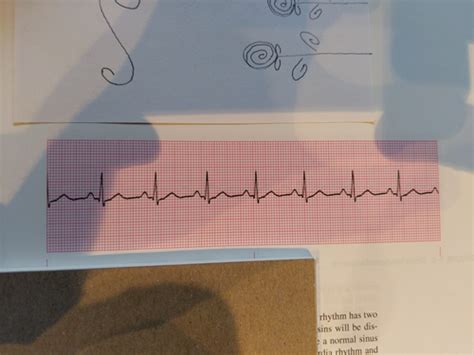 Sinus Rhythms Flashcards Quizlet