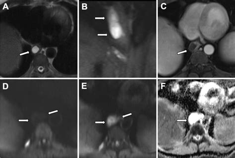 Esophageal Duplication Cyst 32 Year Old Man Came With Upper Gi Download Scientific Diagram